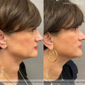 How to know when you're ready for a Spring Thread Lift — Persona ...